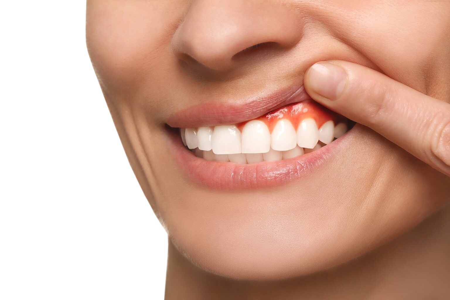How to Treat Infected Gums: A Guide to Healthier Smiles